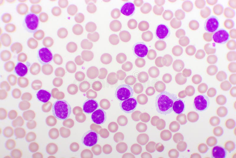 Blood Picture of Chronic Lymphocytic Leukemia or CLL Stock Image ...