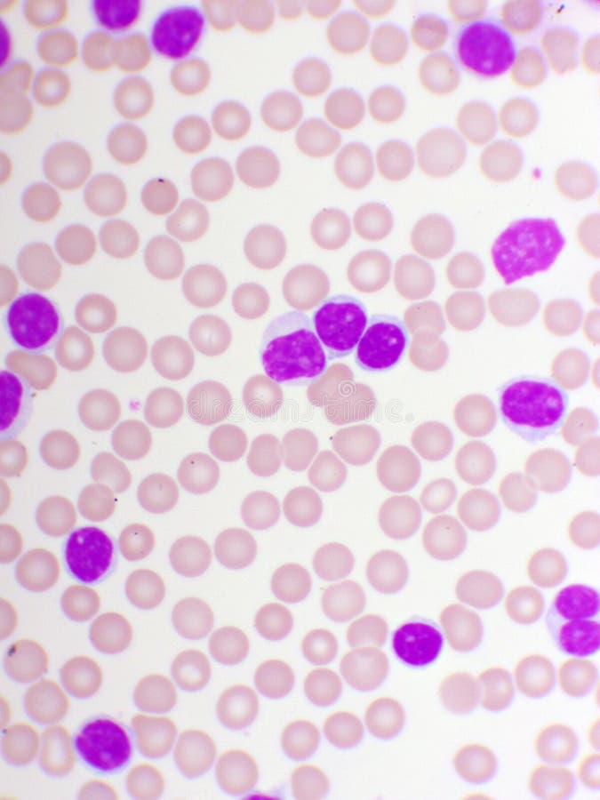 Blood Picture of Chronic Lymphocytic Leukemia or CLL Stock Image ...