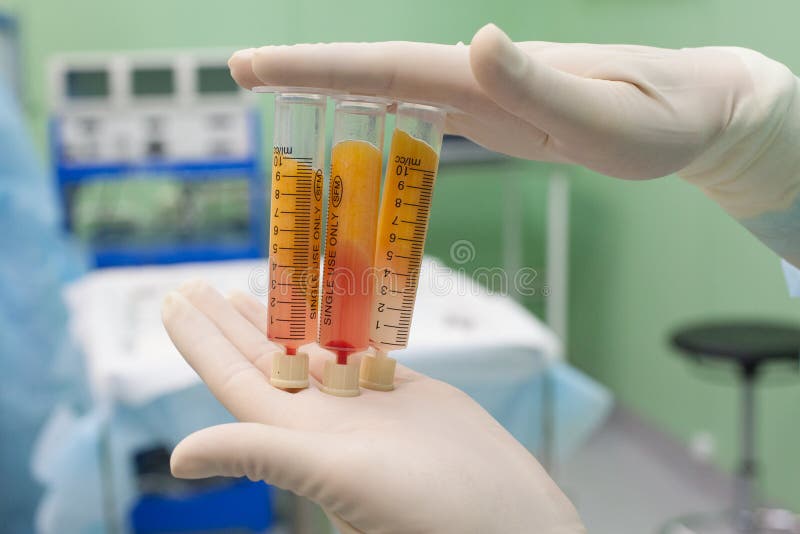 Blood Plasma in Cosmetic Medicine Stock Photo - Image of chemical ...