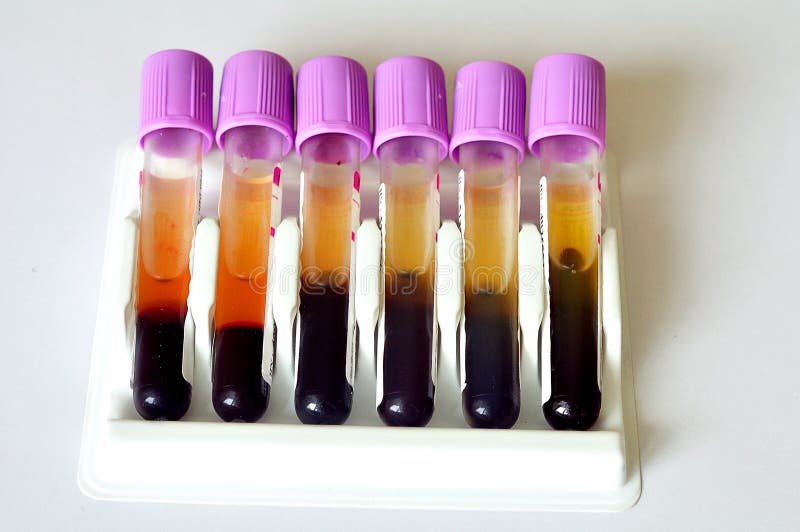 Blood sample for BNP test stock image. Image of infarction - 130187881