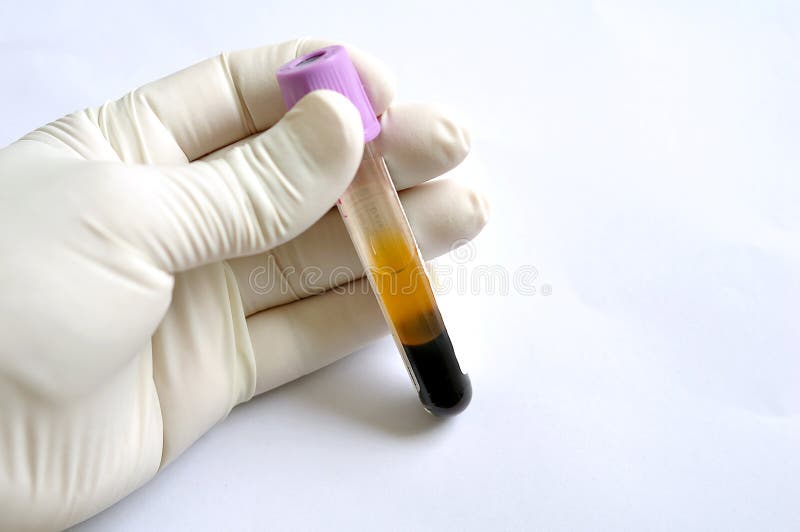Blood Sample For NT-proBNP Test Stock Photo - Image of myocardial ...