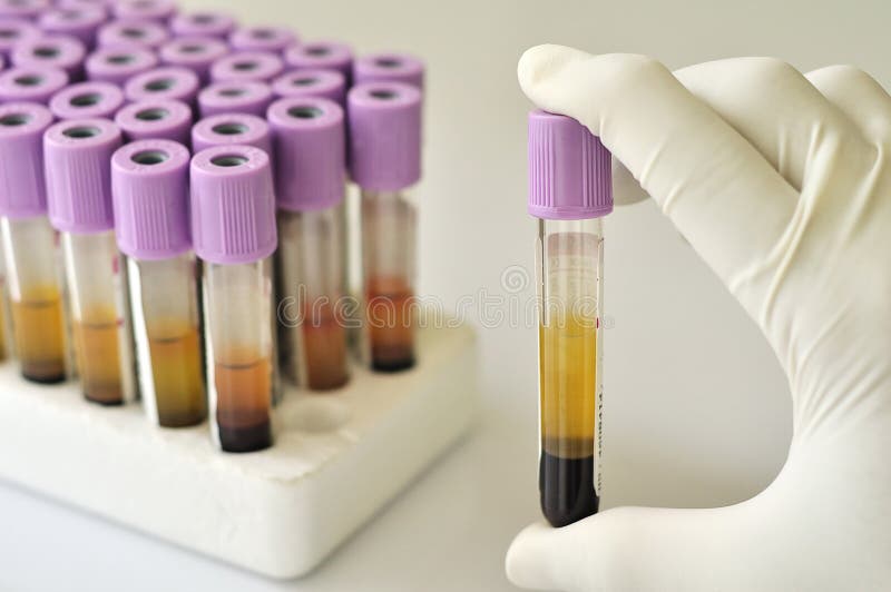 Blood sample stock image. Image of medicine, health, sample - 21415917