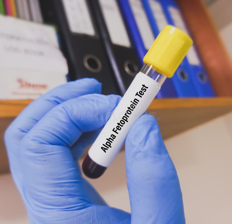 Blood Sample for Alpha-fetoprotein (AFP) Total and L3 Level Testing ...