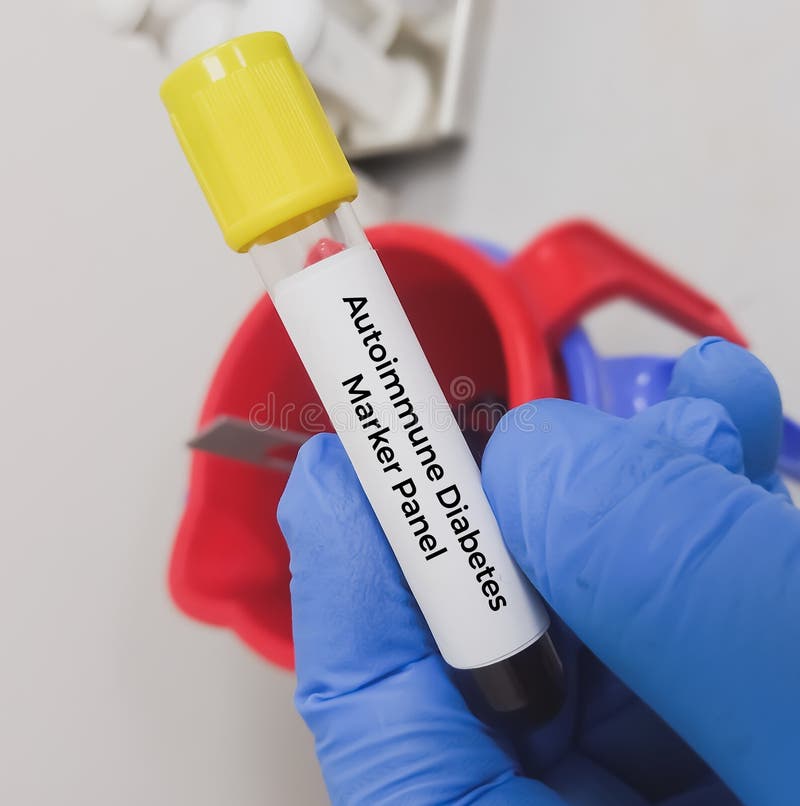 Blood Sample for Autoimmune Diabetes Marker Panel Test. Stock Image ...