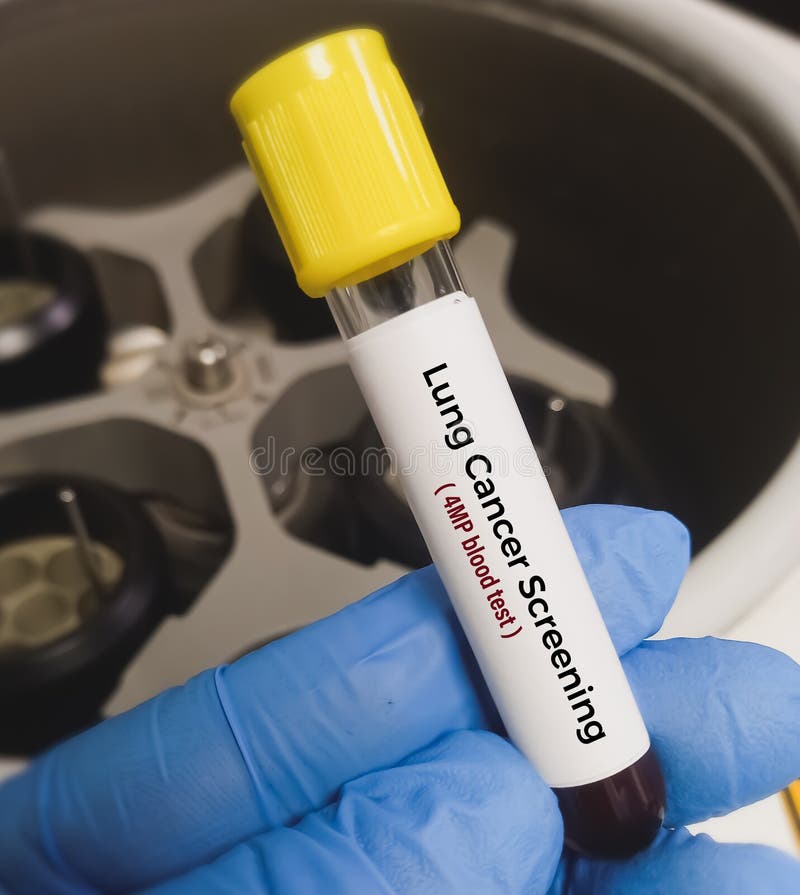 Blood Sample for Blood-based Four-marker Protein (4MP) Panel, Stock ...