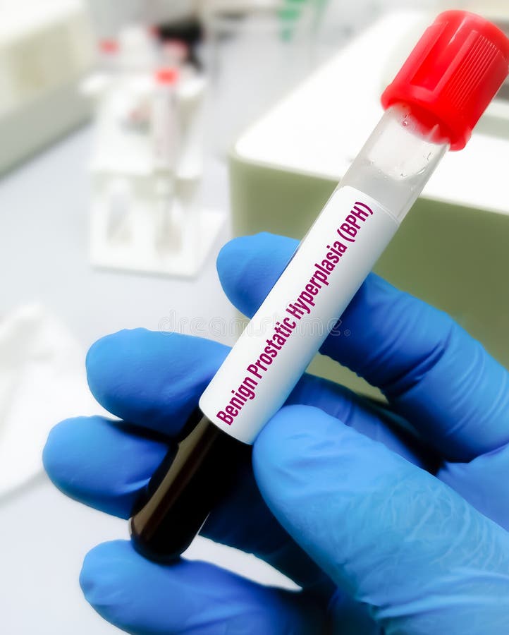 Blood Sample Benign Prostate Hyperplasia (BPH) Test Stock Image - Image ...