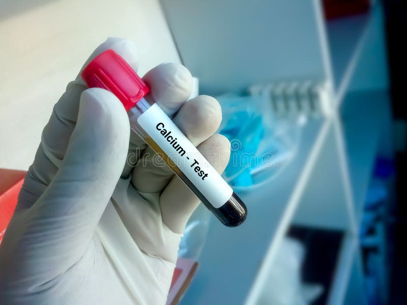 Blood Sample for Calcium Test Stock Image - Image of hypercalcemia ...