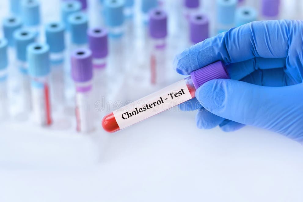 Blood Sample for Cholesterol Testing Stock Photo - Image of cardiac ...