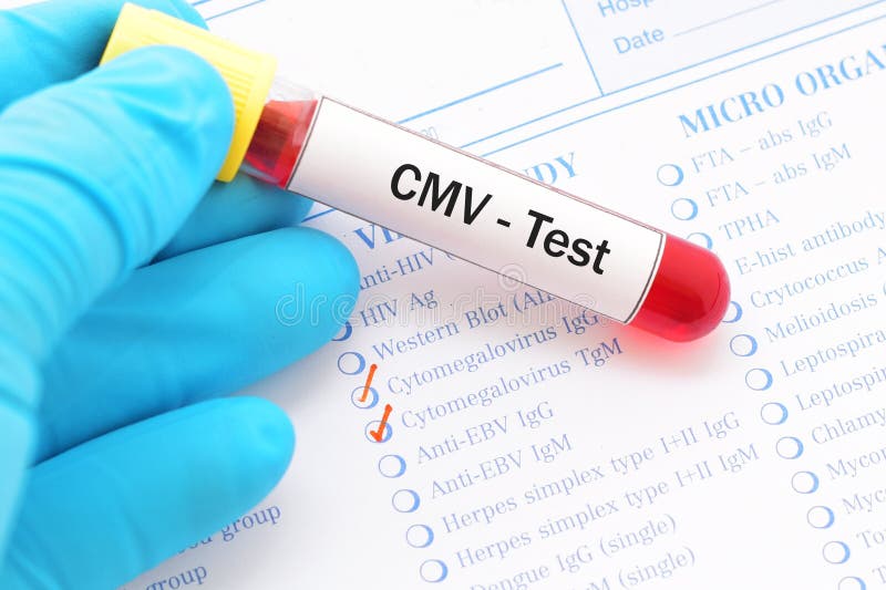 CMV test stock image. Image of hematology, experiment - 101872889
