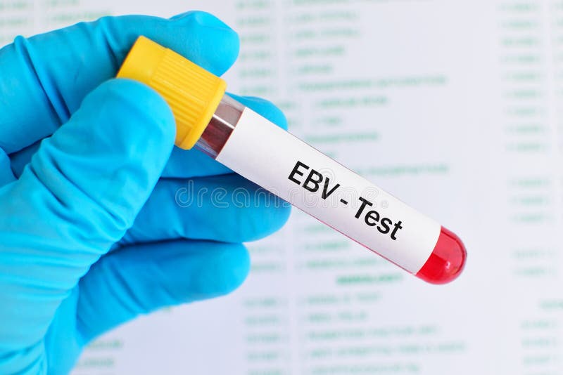 Blood sample for EBV test stock photo. Image of biology - 113078064