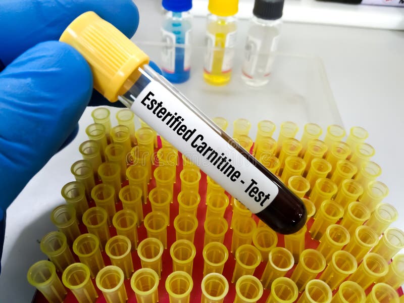 Blood Sample for Esterified Carnitine Test Stock Photo - Image of ...