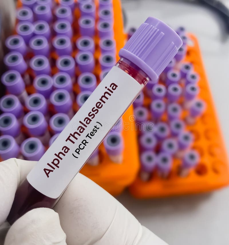 Blood Sample in Hematologist Hand for Alpha Thalassemia PCR Testing ...
