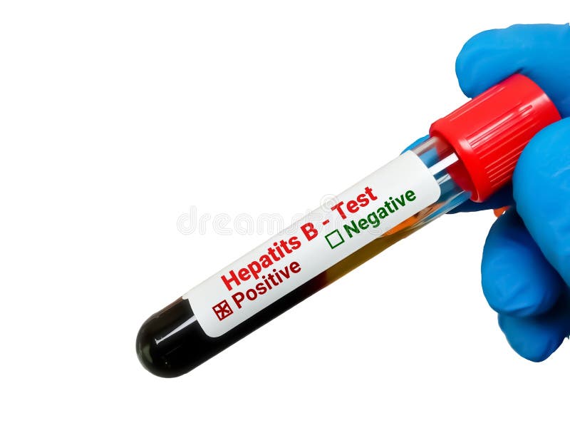 Hepatitis B Virus Test with Copy Space. Stock Image - Image of exam ...