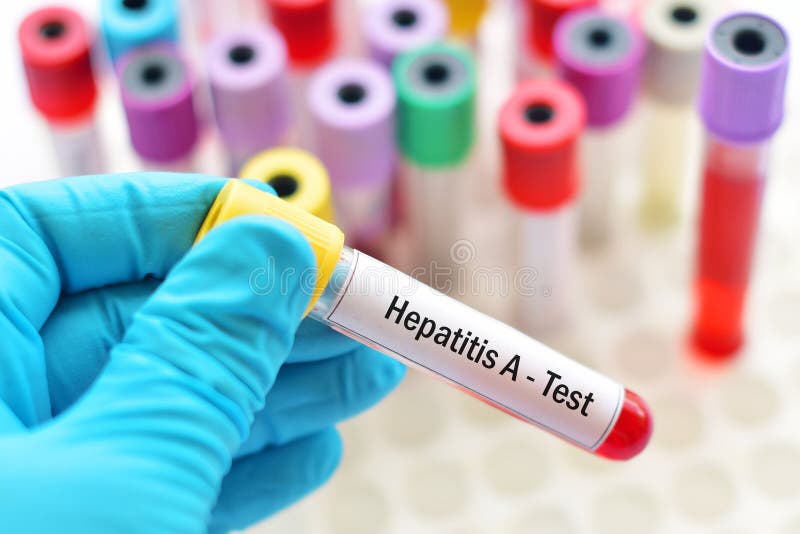 Hepatitis a test stock photo. Image of laboratory, scientific - 102499202