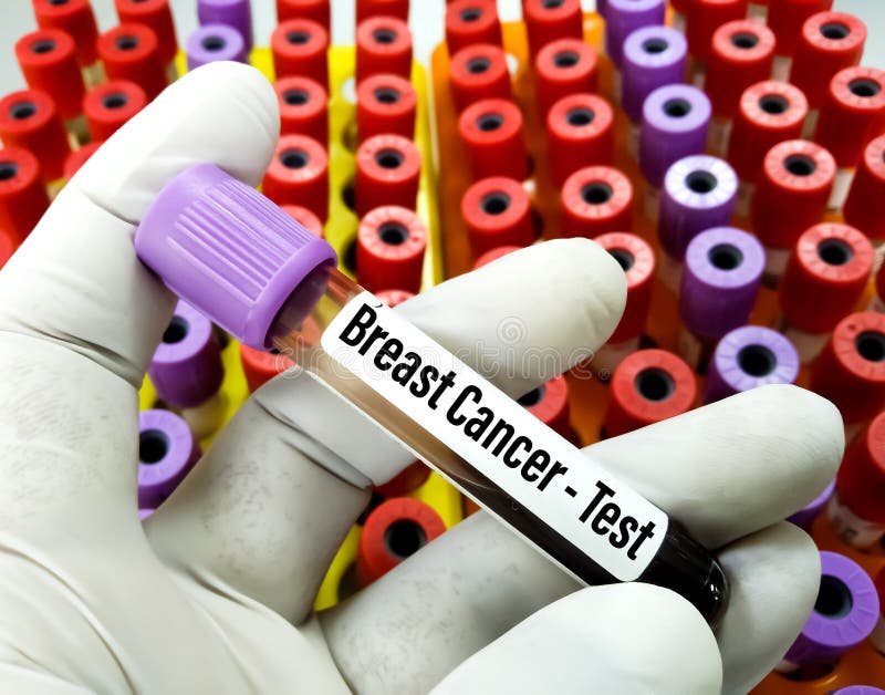 Blood Sample for Breast Cancer Test. Stock Image - Image of cells ...