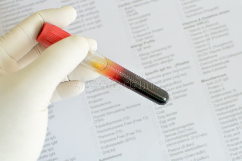 Blood sample for FISH test stock photo. Image of marker - 126803738