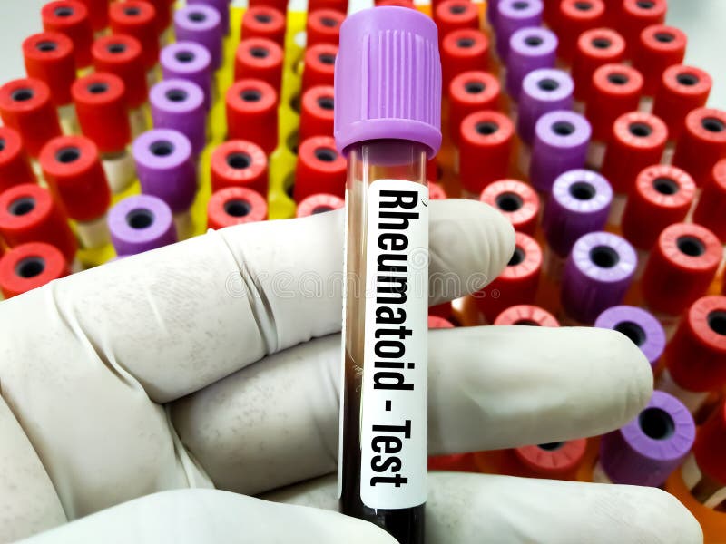 Blood Sample for Rheumatoid Test. Stock Photo - Image of blood ...