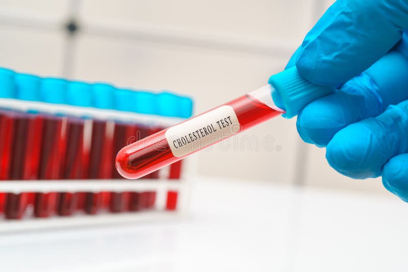 Blood Sample Test Tube in Doctor Hand for Cholesterol Test Stock Image ...