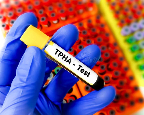 Blood Sample for TPHA Test, Syphilis Testing Stock Image - Image of ...