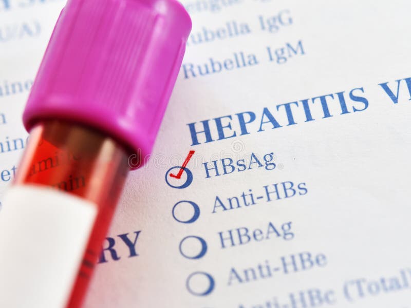 Blood Sample Tube for Hepatitis B Virus Test Stock Photo - Image of ...