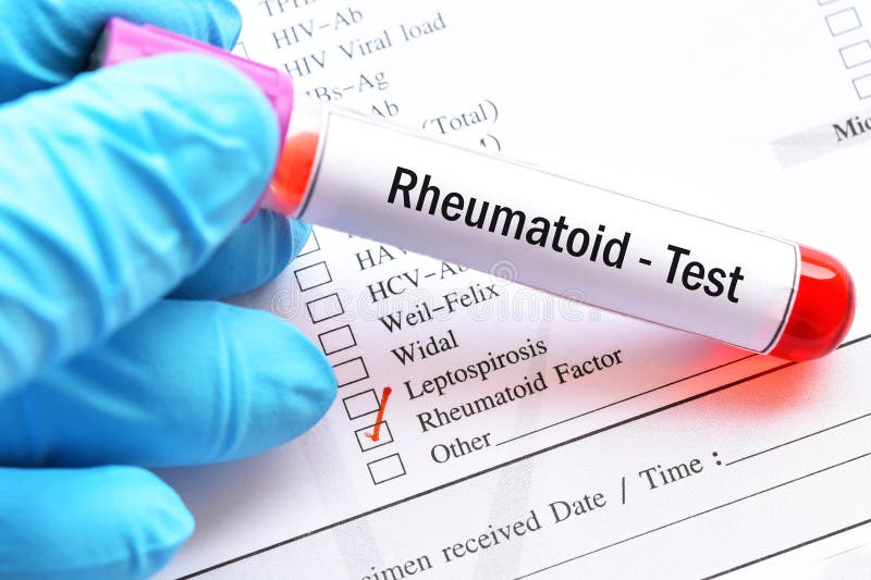 Rheumatoid Arthritis stock image. Image of white, rheumatoid - 66171013