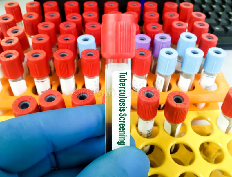 Blood Sample for Tuberculosis Screening Test. Stock Image - Image of ...