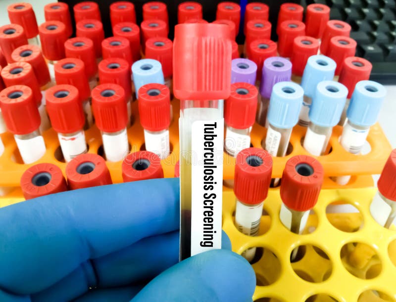 Blood Sample for Tuberculosis Screening Test. Stock Image - Image of ...