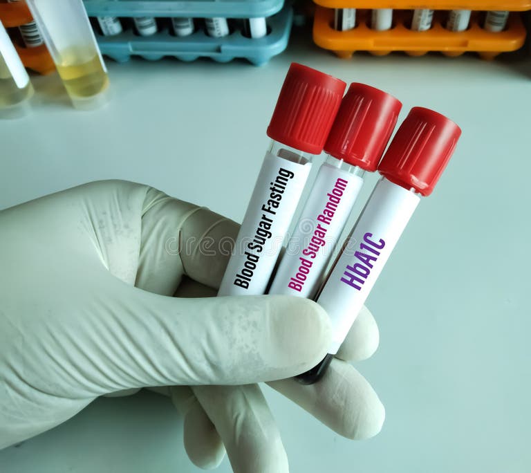 Blood Samples Tube with Sample for Blood Sugar Fasting, Random and ...