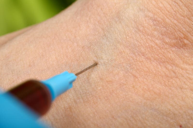 Blood Sampling with Syringe and Needle Stock Image - Image of screening ...