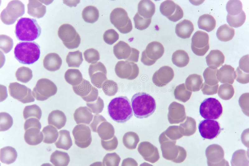 Blood Smear of Chronic Lymphocytic Leukemia Stock Image - Image of ...