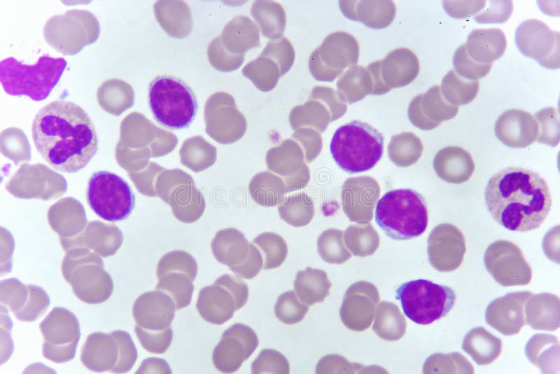 Blood Smear of Chronic Lymphocytic Leukemia Stock Image - Image of ...