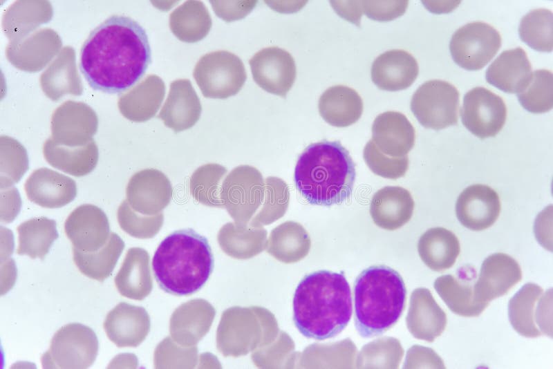 Chronic Lymphocytic Leukemia or CLL Stock Image - Image of platelet ...