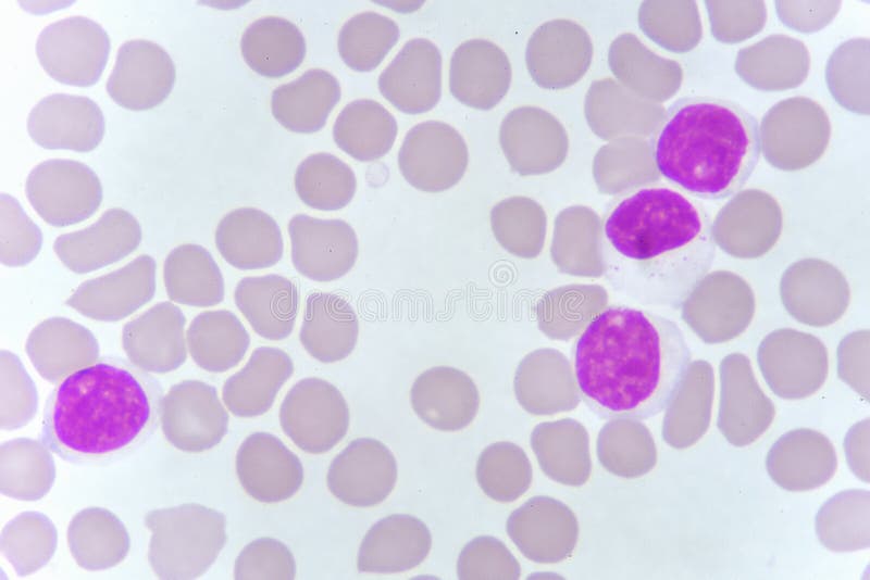 Chronic Lymphocytic Leukemia(CLL) Stock Photo - Image of immune, bone ...
