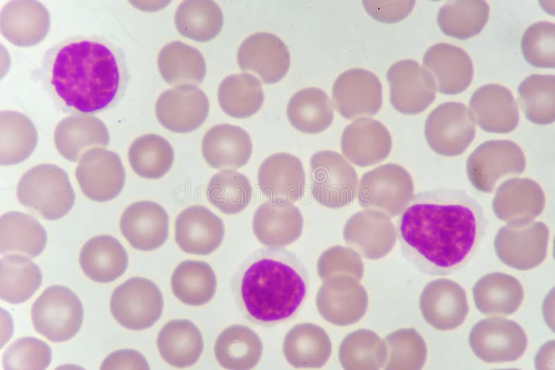 Blood Smear of Chronic Lymphocytic Leukemia Stock Photo - Image of ...