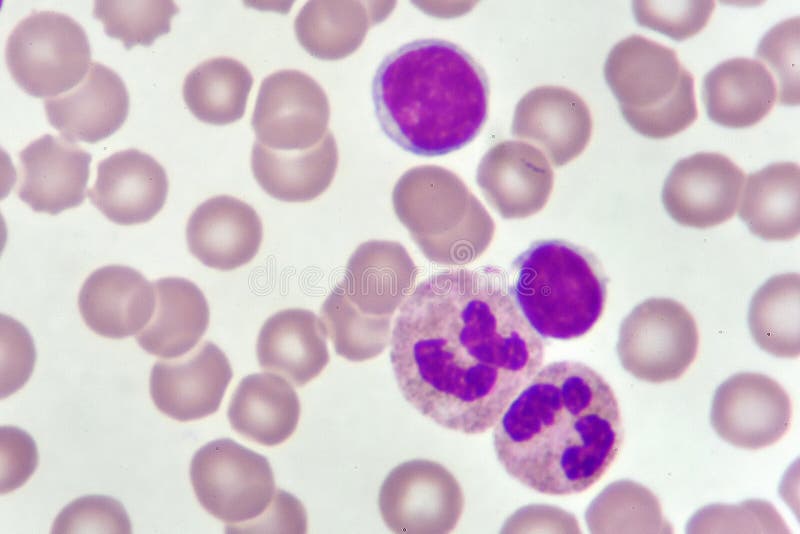 Blood Smear of Chronic Lymphocytic Leukemia Stock Photo - Image of ...