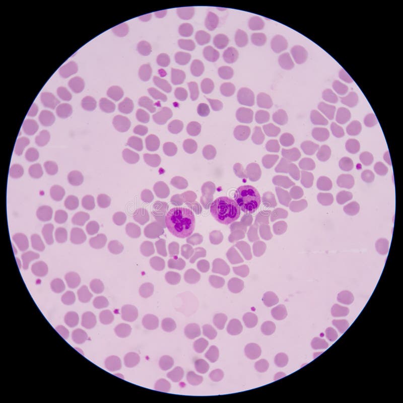 Blood smear form sepsis. stock image. Image of microbiology - 63194297