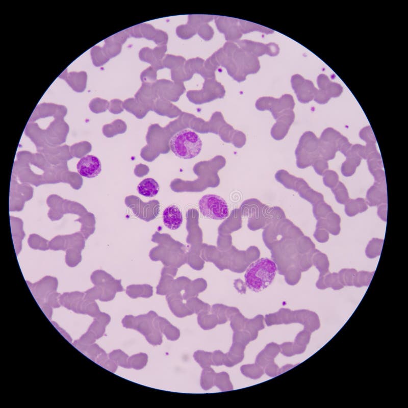 Blood smear form sepsis. stock photo. Image of blood - 63194300