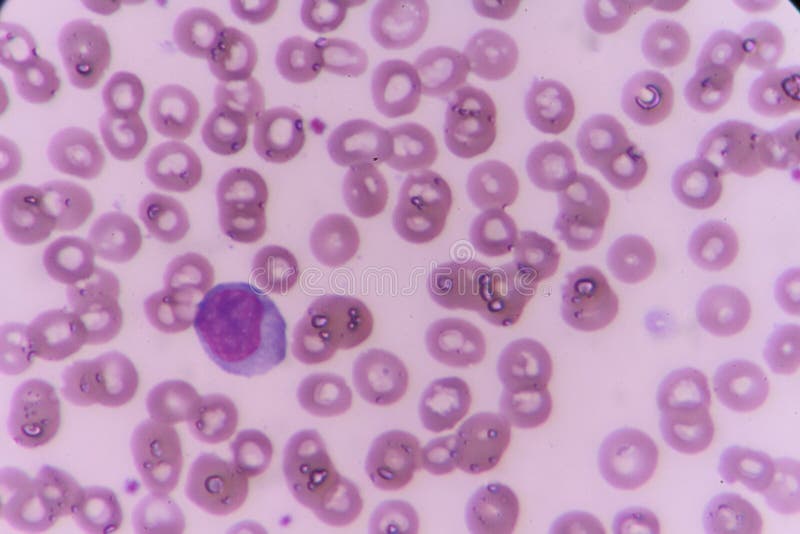 Blood smear stock image. Image of hematology, lymphocyte - 58882561