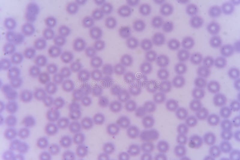 Blood Smear : Red Blood Cells Stock Photo - Image of sample, medical ...