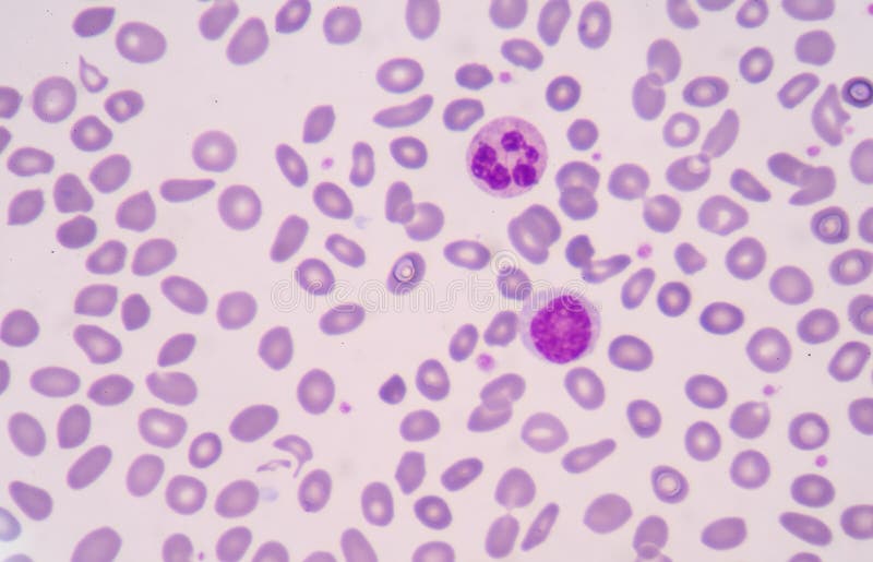 Blood smear stock photo. Image of disease, malignancy - 65642844