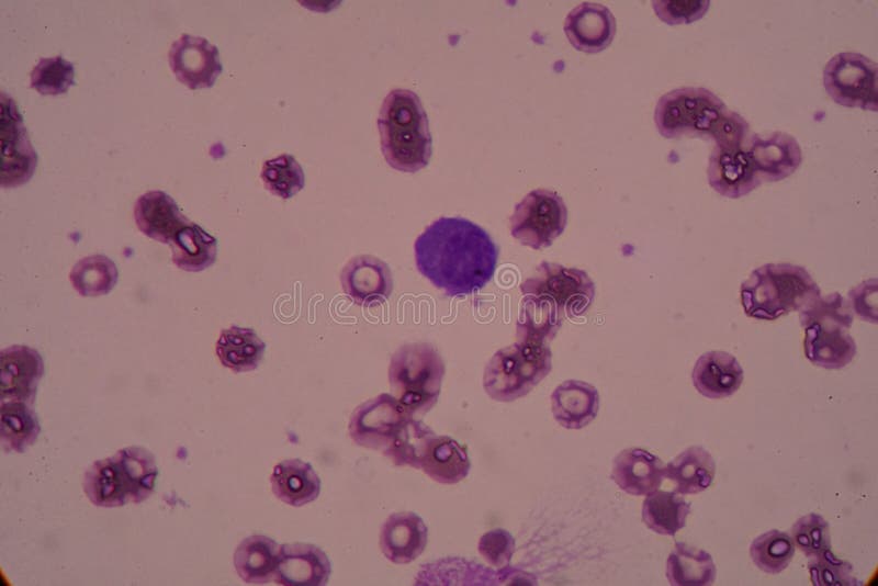 Blood Smear Under Microscope is Showing Normal Red Blood Cell. Stock ...