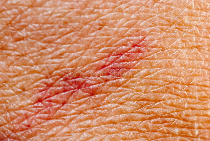 Blood stasis skin texture stock photo. Image of closeup - 18622786