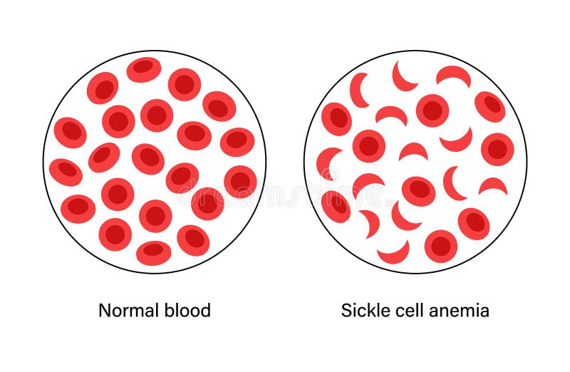 Anemia. Comparison of a Drop of Blood with Normal and Anemic Blood ...