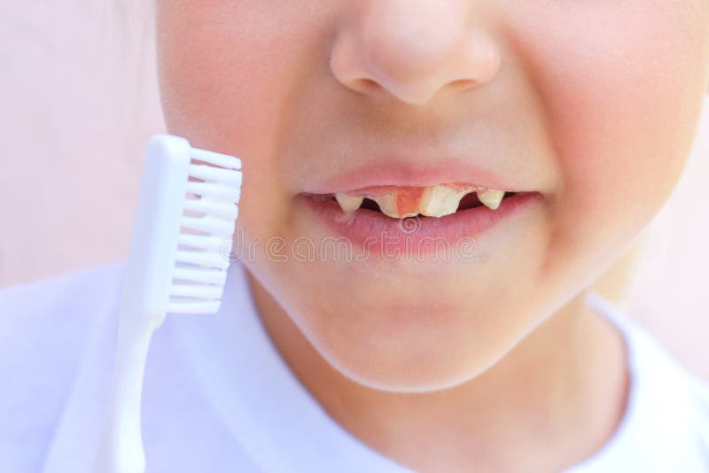 Blood on the Teeth of a Child Stock Photo - Image of prevention ...