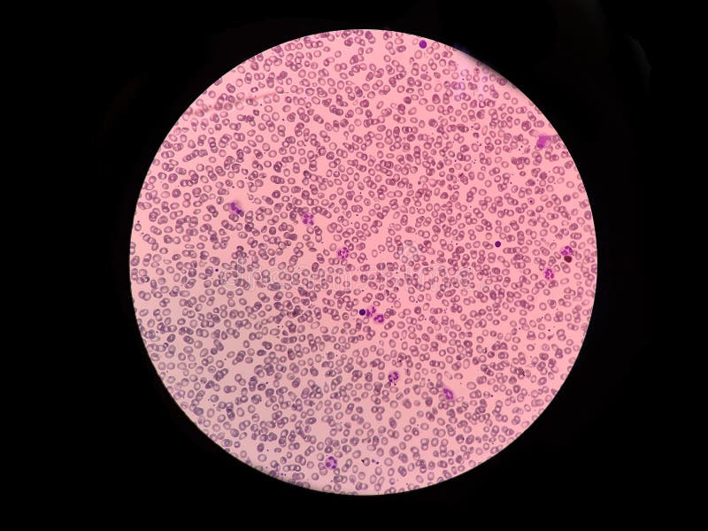 Blood Test, Red Blood Cells Stock Image - Image of laboratory, smear ...