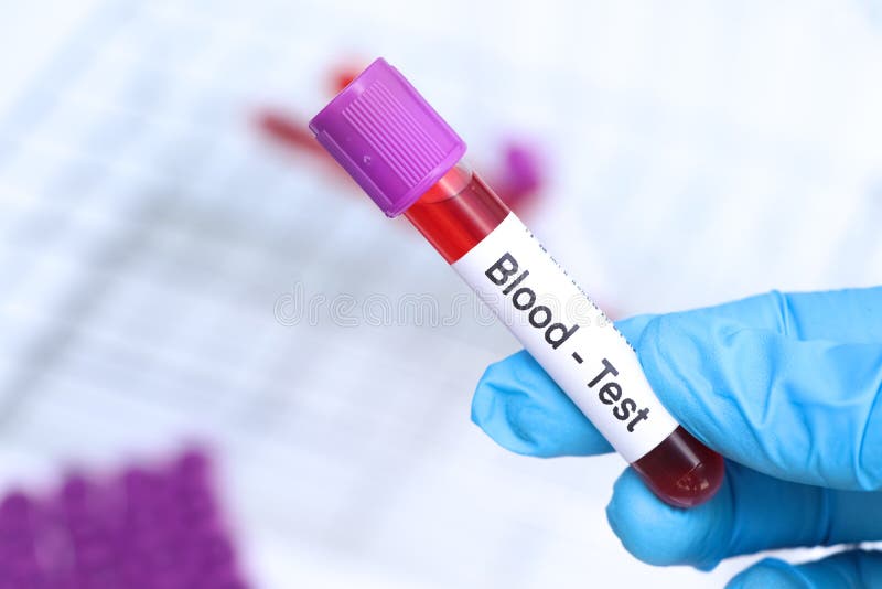 Blood Test To Look for Abnormalities from Blood, Blood Sample To ...