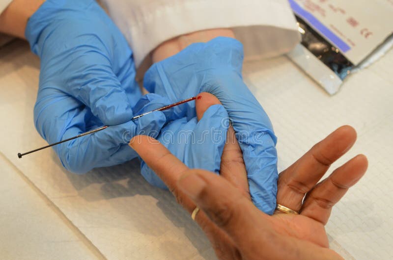 Blood Clotting And Clot Formation. Thrombus In The Blood Vessels. Stock ...