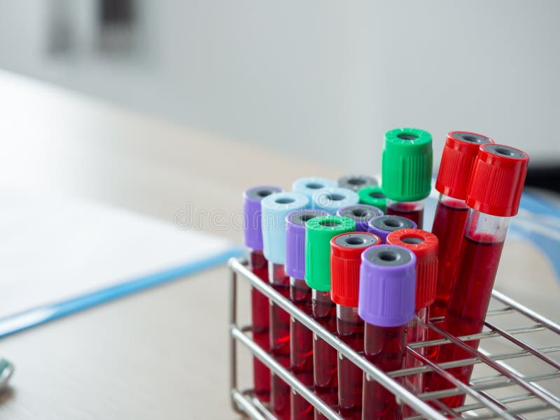 Blood Tubes and Results Chart on the Table. Virus Testing or ...