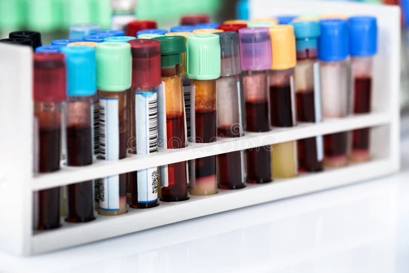 Blood Tubes Samples in Tray in the Laboratory Stock Image - Image of ...