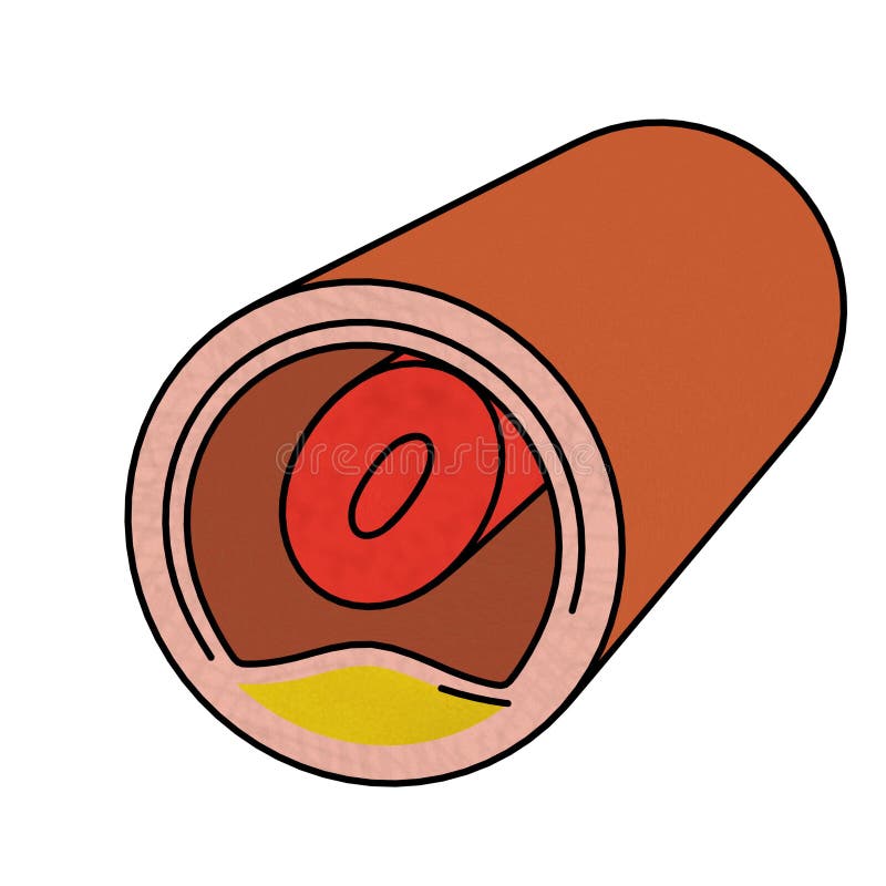 Blood Vessel with Cholesterol Stock Illustration - Illustration of ...